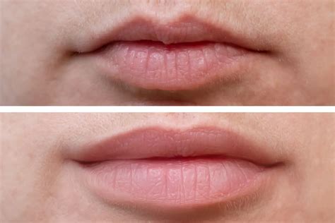 What Are The Pros And Cons Of Lip Fillers Md Spa