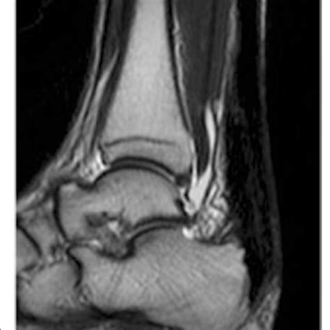 Preoperative Magnetic Resonance Imaging Parts Of The Achilles Tendon