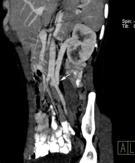 Radiodiagnosis Imaging Is Amazing Interesting Cases Renal Vein