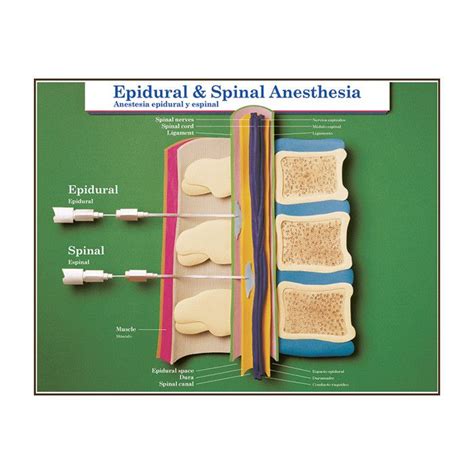 Spinal Tap Vs Epidural Pain Mapasgmaes