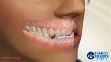 What Are Underbite Braces And How Do They Work To Correct Underbites