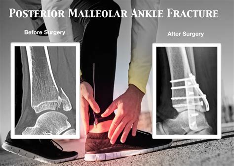 Posterior Malleolar Robert Sheinberg Dpm Weston Fl Podiatrist