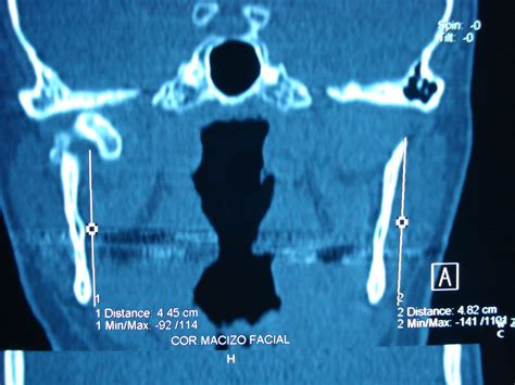 Dr Miguel Angel Marroquín Fractura De Condilo Mandibular