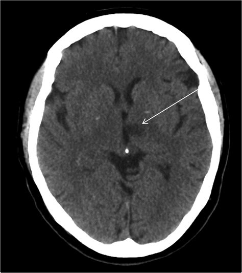 A Chamber Of Secrets The Neurology Of The Thalamus Lessons From Acute