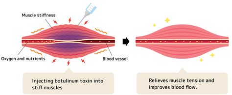 Deans Stroke Musings Botulinum Toxin Injections For Stroke Rehabilitation