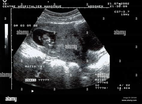 Fibrome utérin l échographie Photo Stock Alamy