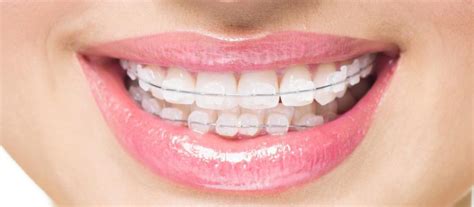 Craft Your Smile Straighten Teeth Without Braces Pediatric Dentist
