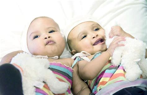 Twin Girls Joined At Head Separated Thetimes Tribune