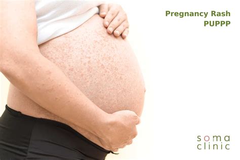 Puppp Rash 7 Little Known Ways To Sooth Your Pregnancy Rash No Steroids