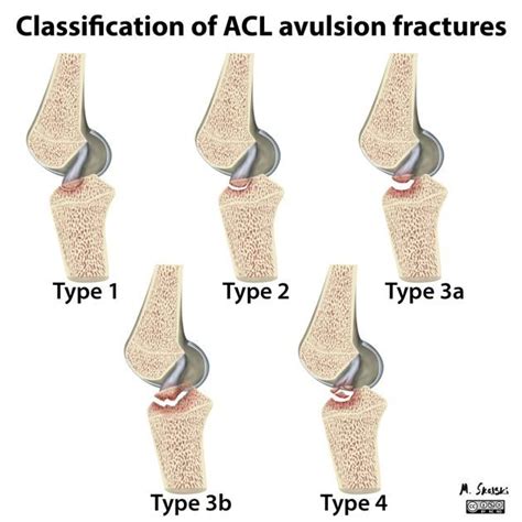 Classification Of Acl Avulsion Fractures Diagram Artofit