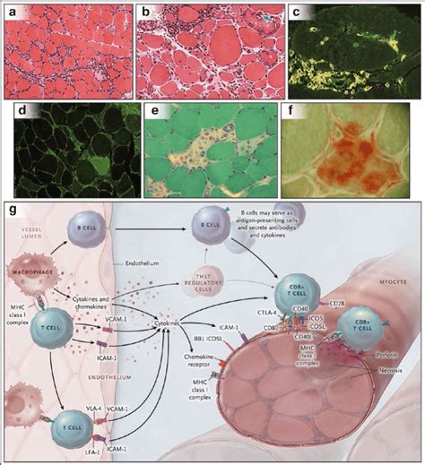 Immune Mediated Necrotizing Myopathy
