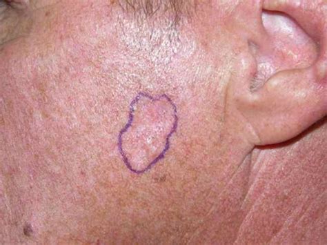 Mohs Micrographic Surgery Arizona Dermatology Specialists Surprise