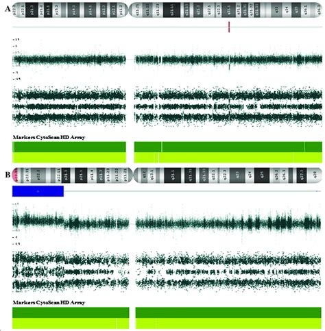cma data of the proband with genomic imbalances in 7 and x chromosomes