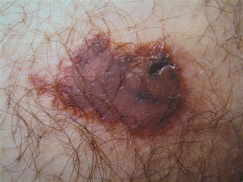 Inflammatory Papules Flashcards Quizlet