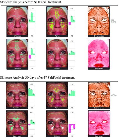 Aging Skin Patient Note Improvement In Graphs After Salt Facial