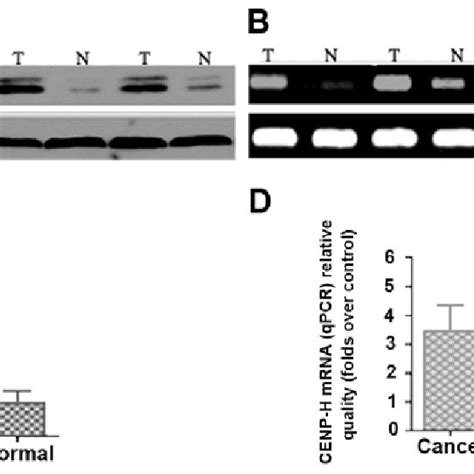 Cenp H Mrna And Protein Expression In Hcc And The Corresponding