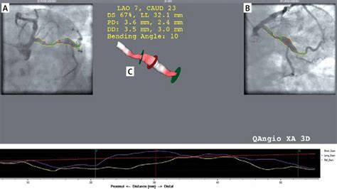 3d Reconstruction C Based On 2d Angiographic Projections A And B Download Scientific