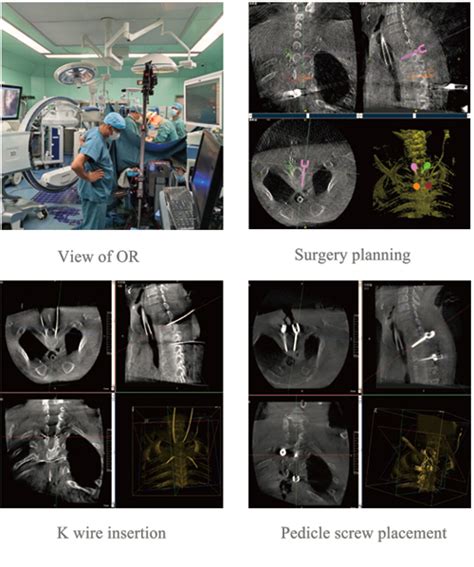 Spine Surgery Robot Spine Surgical Navigation System PerLove