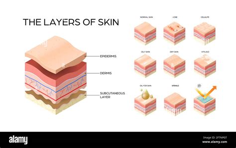 Layers Of Skin In C Section At Ava Ewers Blog