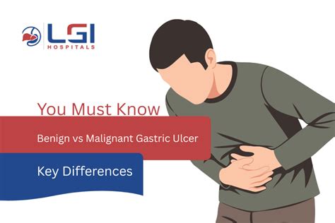 Benign Vs Malignant Gastric Ulcer Archives Lgi Hospitals