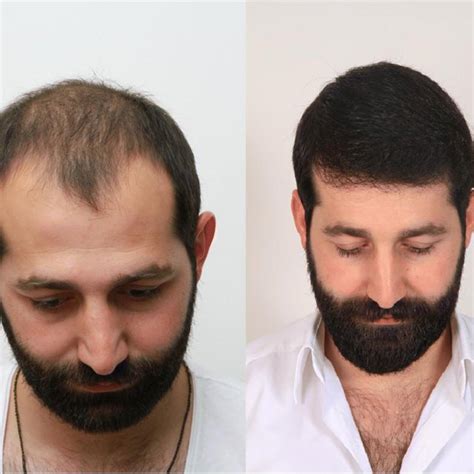 36 Year Old Male Patient Preoperative Vs Postoperative 1st Year 5000