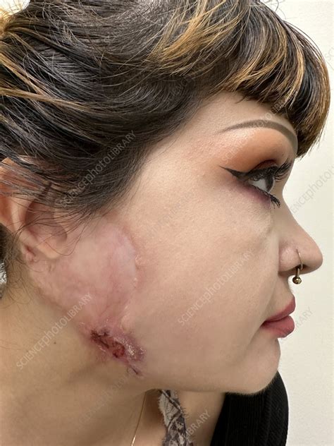 Pyoderma Gangrenosum Treated With Infliximab Stock Image C060 7575 Science Photo Library