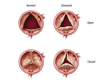 Heart Valve Disease Information Edwards Lifesciences