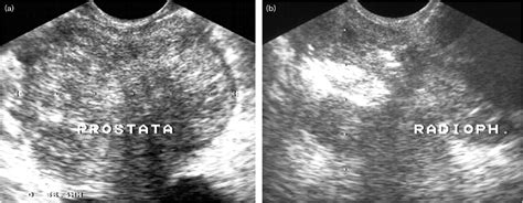 Use Of The Gamma Probe In Sentinel Lymph Node Biopsy In Pati