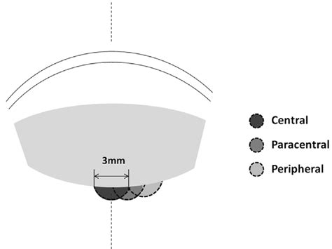 Classification Patterns Of The Different Cataract Locations Download Scientific Diagram