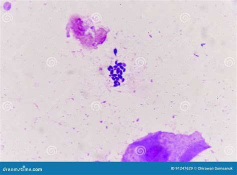 Budding Yeast Cells With Pseudohyphae In Urine Sample On Wright Gimsa
