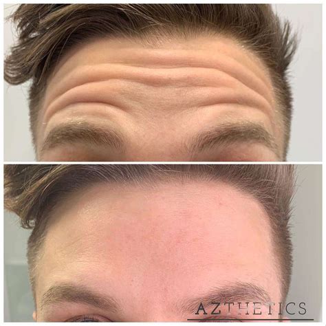 Botox Before And After Men Botox For Men Male Botox Mens Botox