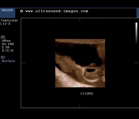 Cochinblogs 3 D Ultrasound Of Bilateral Hydrocele