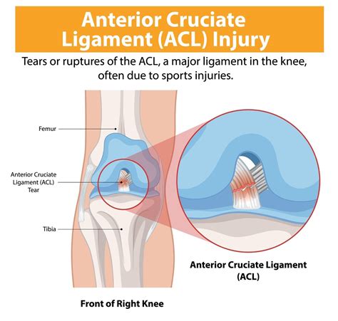 Preventing Acl Injuries Common Causes And The Role Of Physical Therapy