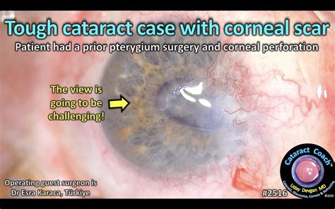 Tough Cataract Surgery With Corneal Scar From Prior Trauma