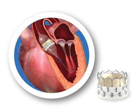 Tavi Tavr Procedure Heart Valve Experts
