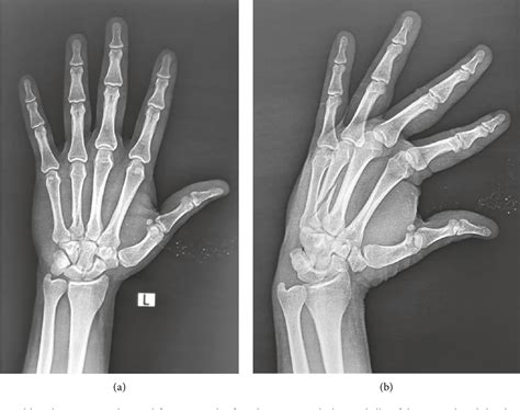 Figure 1 From A Single Intramedullary K Wire Is Sufficient For The Management Of Nonthumb