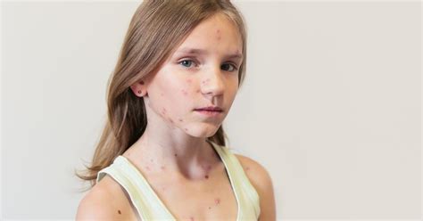 Varicelle les symptômes fréquents et l évolution