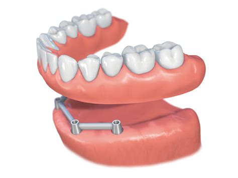 Straumann Implant Bar Dental Masnic