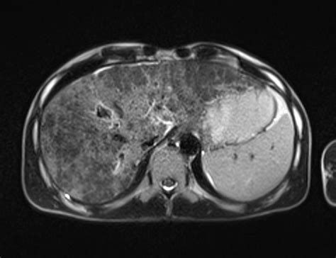 Primary Biliary Cirrhosis Pacs