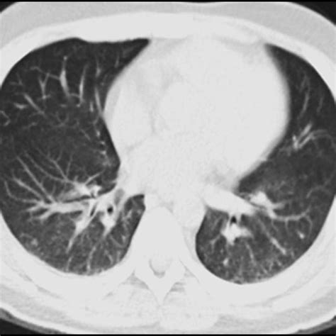 Thoracic Computed Tomography After 48 Days Of Steroid Use Download