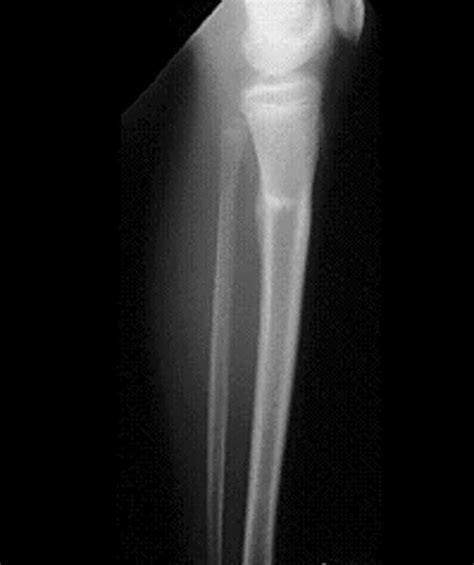 Stress Fracture Of The Proximal Tibia Download Scientific Diagram