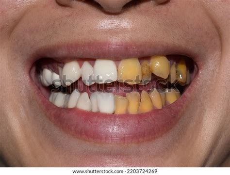 Comparison Before After Scaling Polishing Treatment Stock Photo Shutterstock