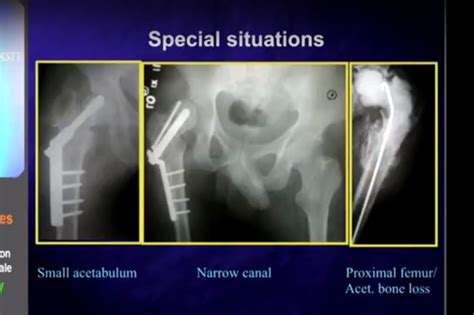 Management Of Periprosthetic Hip Infection With Spacers