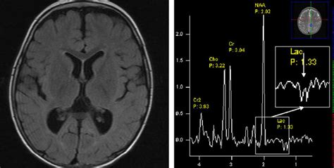 Patient With Mitochondrial Respiratory Chain Defect Complex I