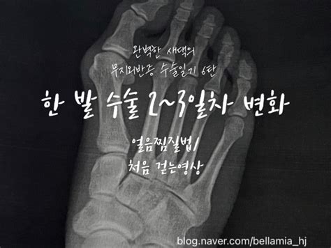 무지외반증 수술후기 6 얼음찜질법 처음 걷는 영상 수술 2 3일차 네이버 블로그
