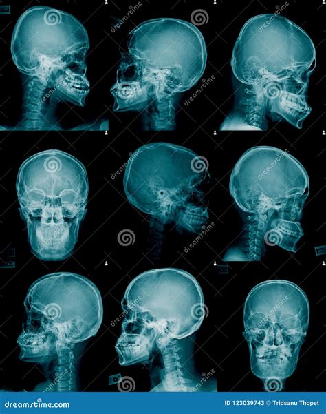 Collection Skull X Ray Ap And Lateral View Stock Image Image Of