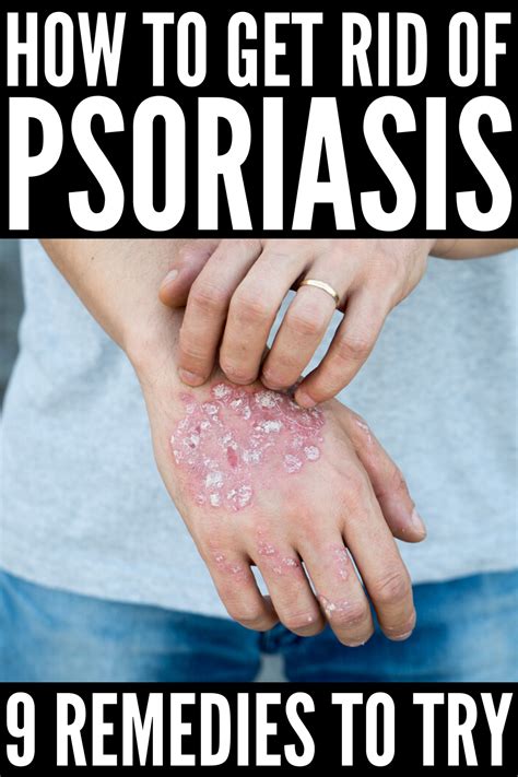 How To Treat Psoriasis Artofit