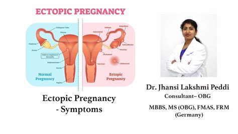 Sakra World Hospital On Linkedin Dr Jhansi Lakshmi Peddi On Ectopic