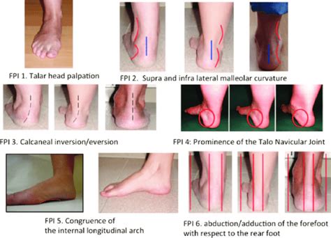 The Foot Posture Index The Medical Dispatch