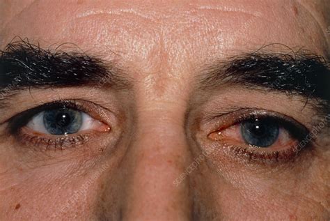 Man With Acute Iritis Stock Image M1550120 Science Photo Library